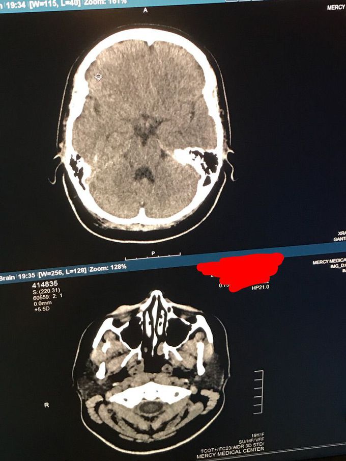 Normal head CT - MEDizzy