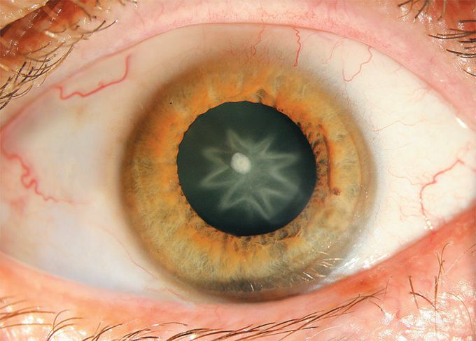 A man in Austria developed a cataract shaped like a star in - MEDizzy