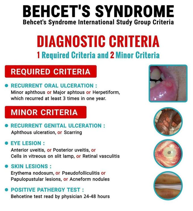 Behcet Syndrome - MEDizzy