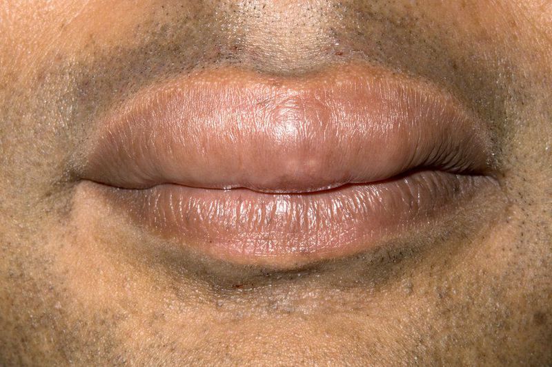 ANGIOEDEMA & ANTI HYTAMNIQUE drug - MEDizzy