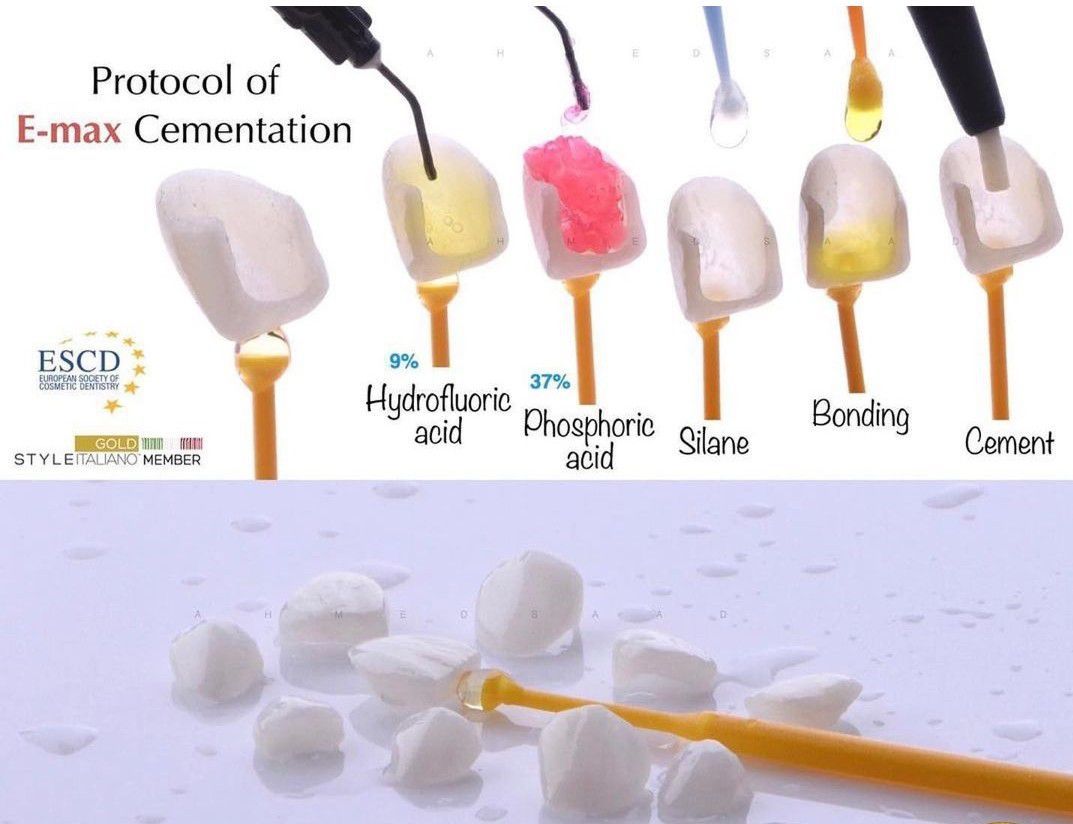 Protocol Of Emax Cementation MEDizzy