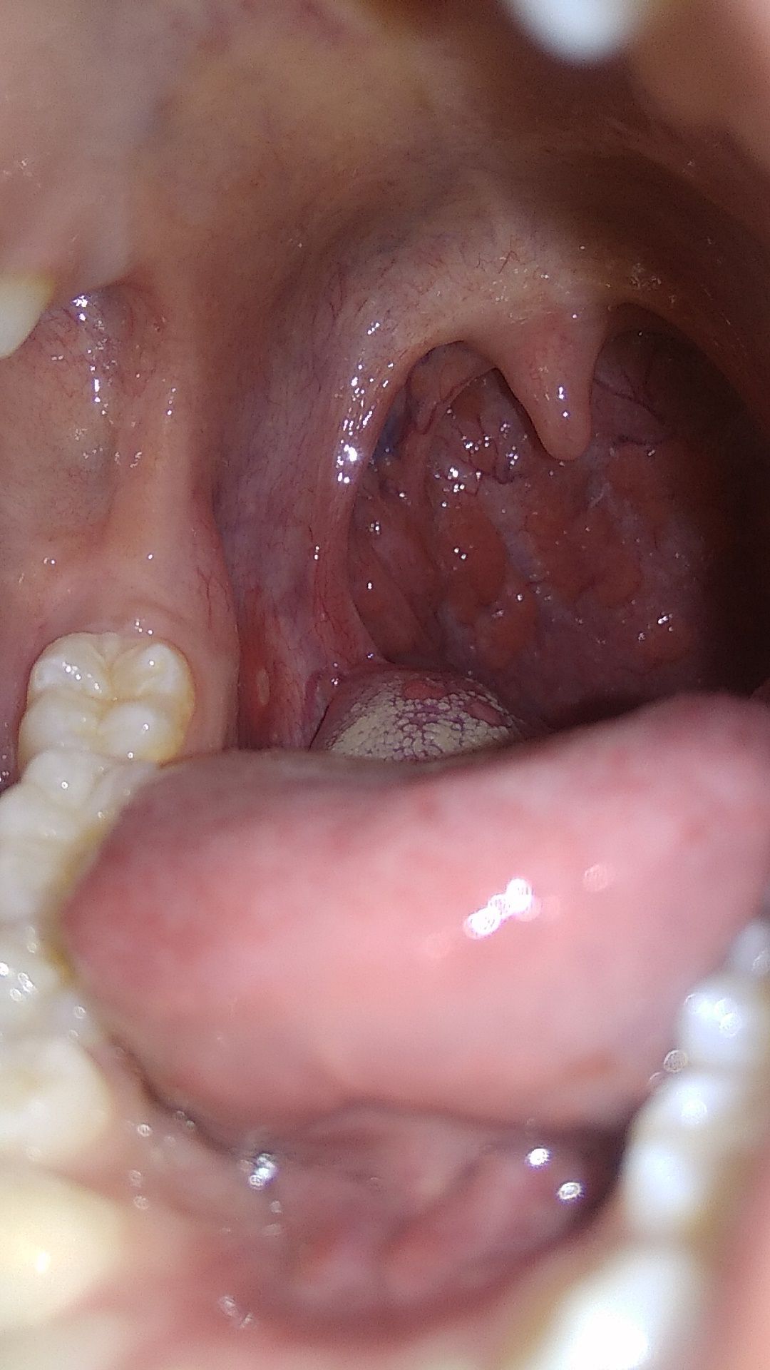 Canker Sore On Tonsils
