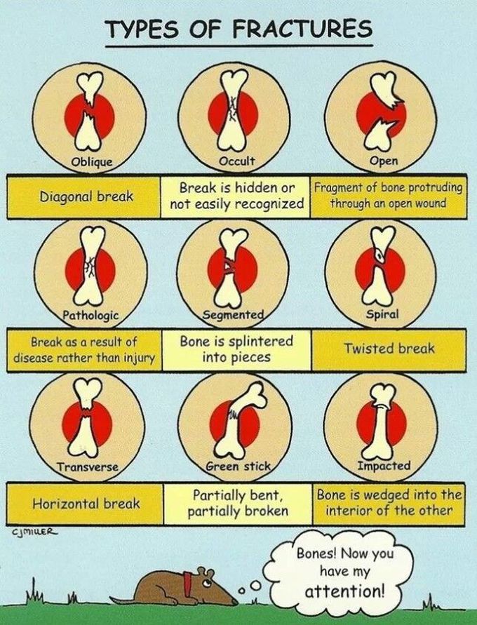 Types of fractures - MEDizzy