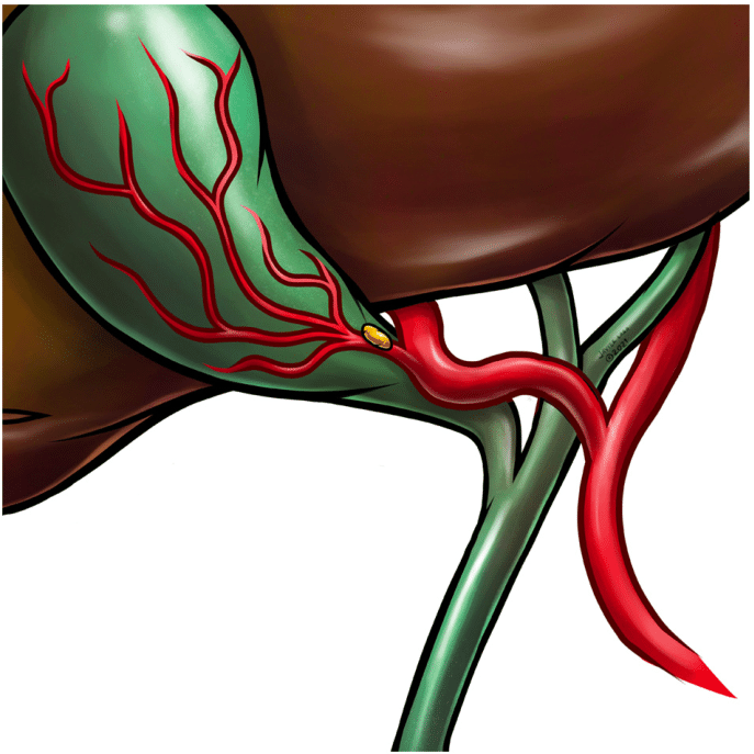 Moynihan's hump - MEDizzy