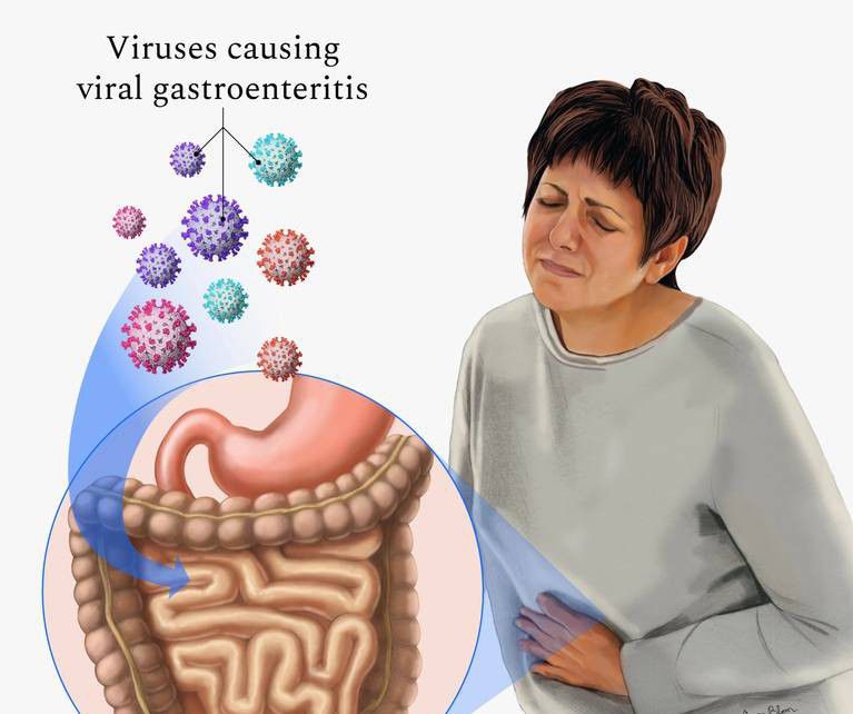 Gastroenteritis - MEDizzy