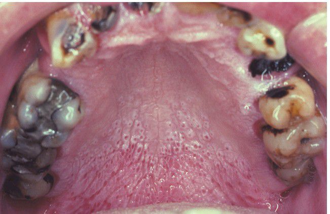 Nicotine Stomatitis Images Vaping Linked To AD, PsO, Burns, And More