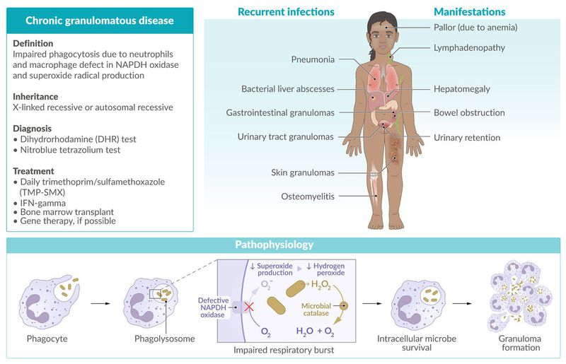 Chronic Granulomatous Disease Pathology Outlines Chronic