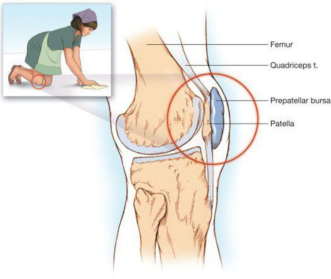 The Housemaid s Knee MEDizzy
