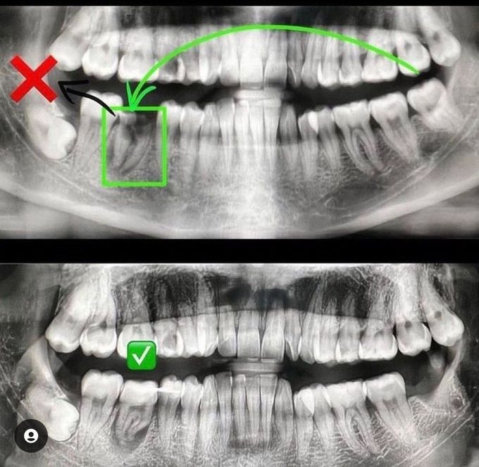 Autotransplantation MEDizzy