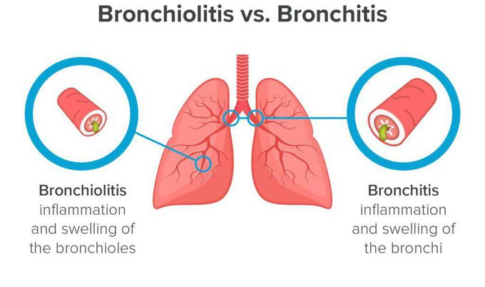 Bronchitis - MEDizzy