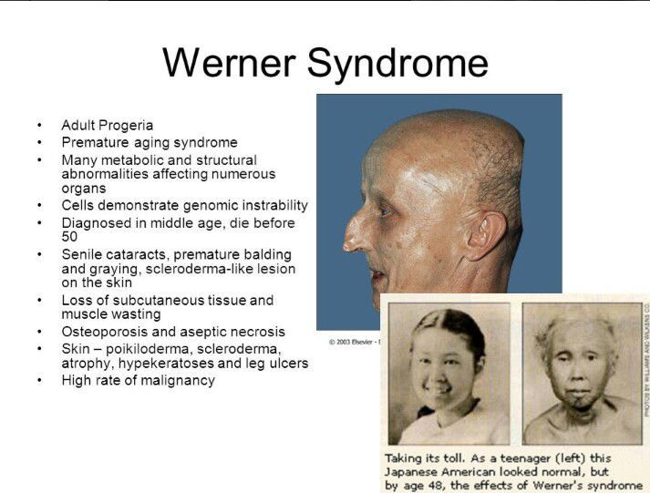 Werner Syndrome Progeria Adult 15 Fascinating Facts About Progeria,