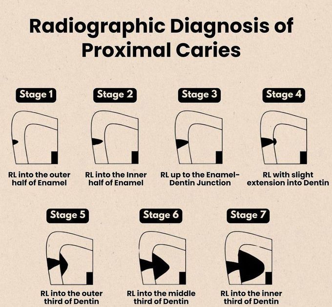Radiographic Diagnosis of Proximal Caries - MEDizzy