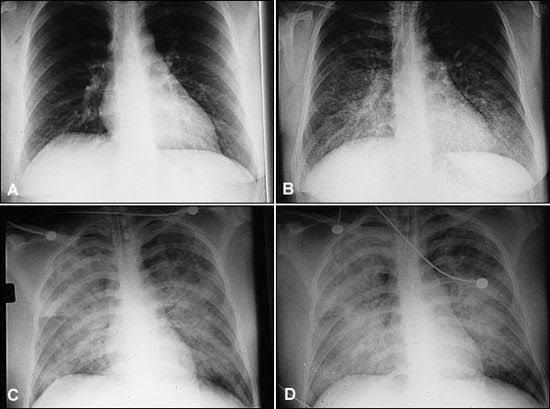 Hantavirus pulmonary syndrome symptoms - MEDizzy