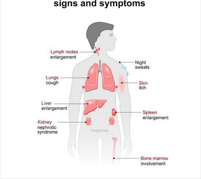 These are the symptoms of Lymphona - MEDizzy