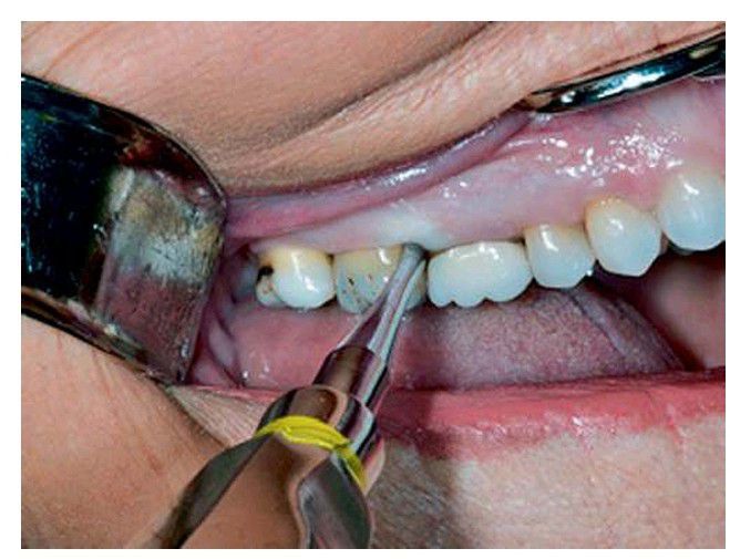 Luxation of tooth - MEDizzy