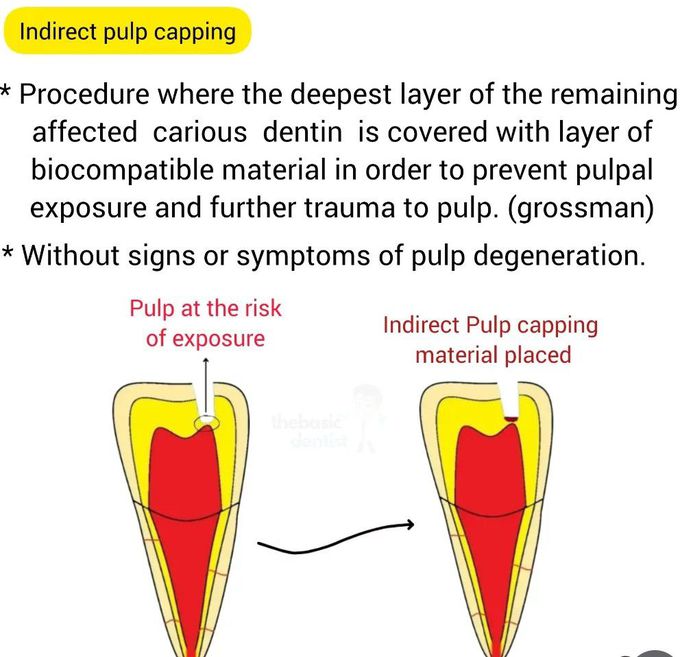 Pulp Capping II - MEDizzy