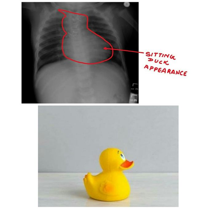 sitting duck appearence seen in ? - MEDizzy