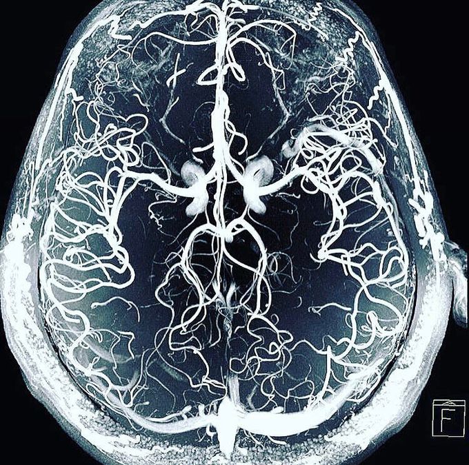 MR angiogram of the vasculature of the Circle of Willis - MEDizzy