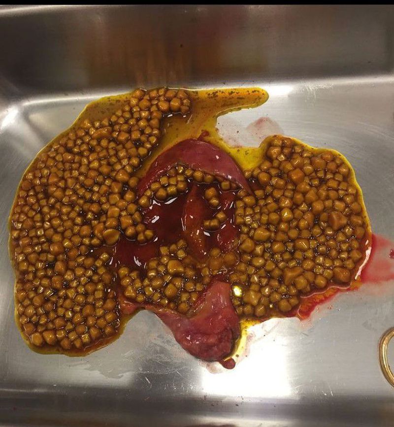 Real Gallbladder Stones Gall Stones Hi Res Stock Photography And