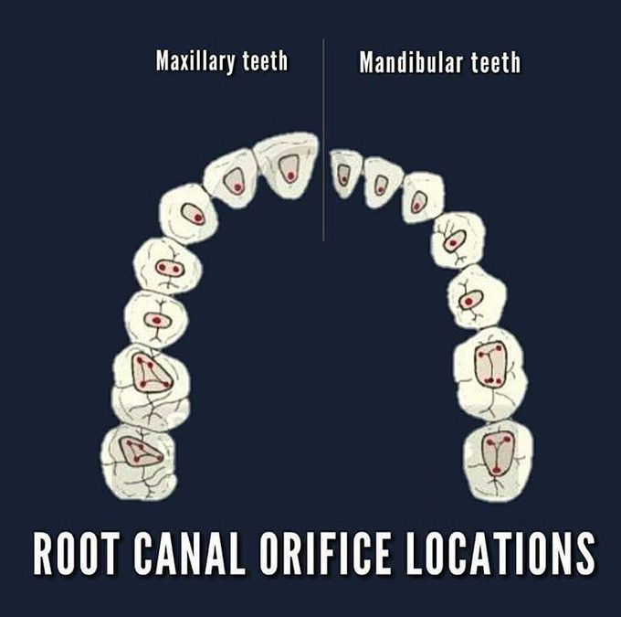 Root canal orifice locations in maxillary & mandibular - MEDizzy