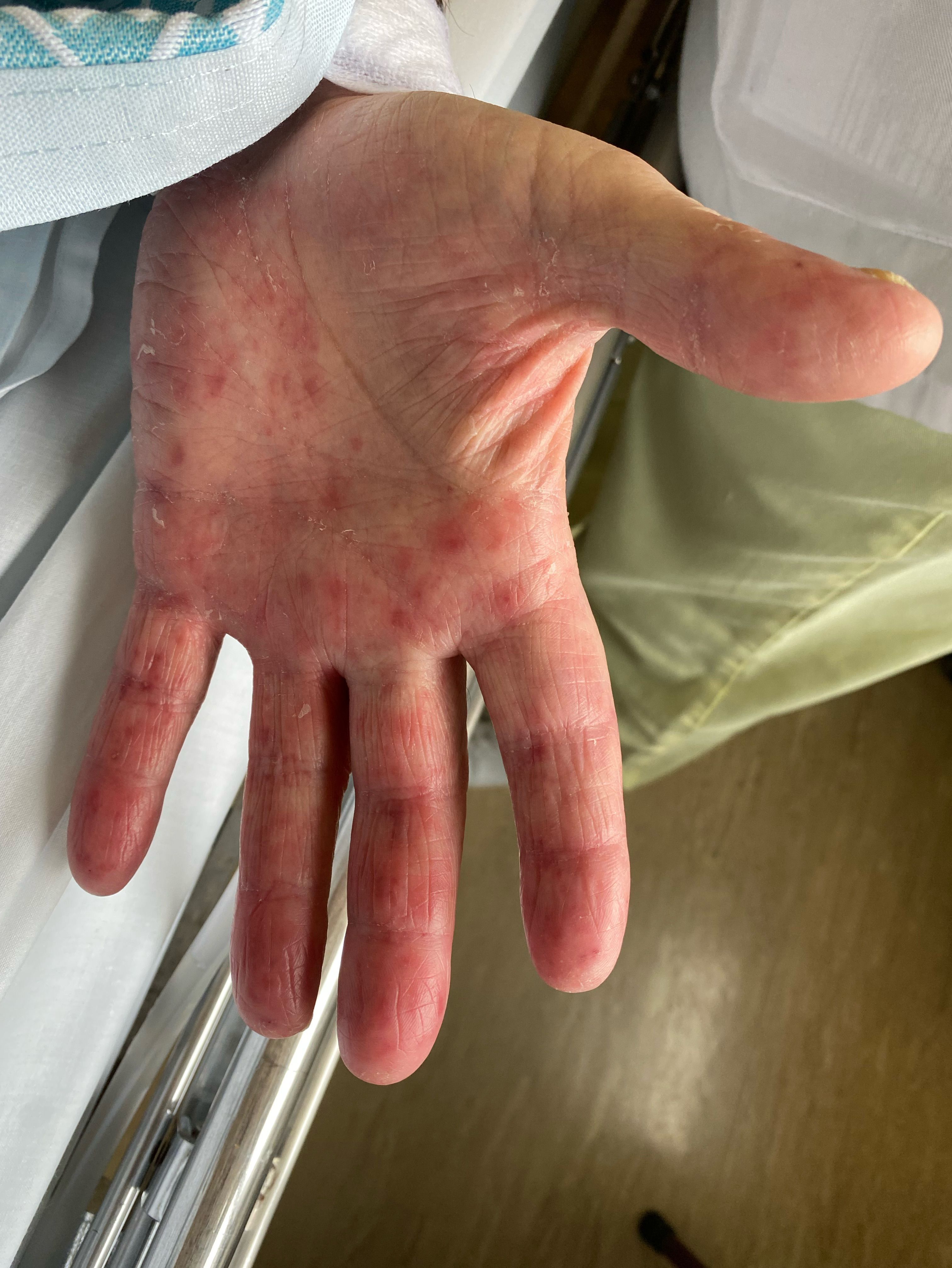 Lesiones De Janeway Endocarditis On X: "Otros Síntomas Relacionados