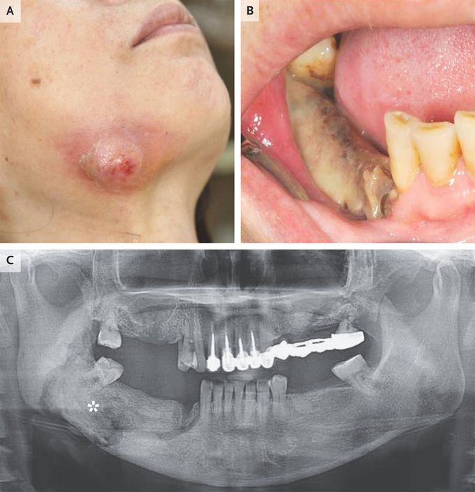 Medication Related Osteonecrosis Of The Jaw MEDizzy