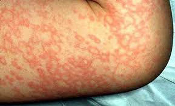 Identify the rash? Diagnosis? - MEDizzy