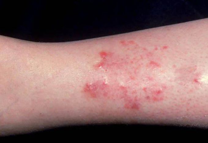 Symptoms of Stasis dermatitis - MEDizzy