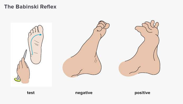 This is how bebinski sign looks like! - MEDizzy