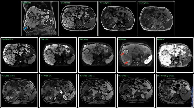 MRI Liver Imaging w/Primovist – Polycystic Liver @ Siemens - MEDizzy