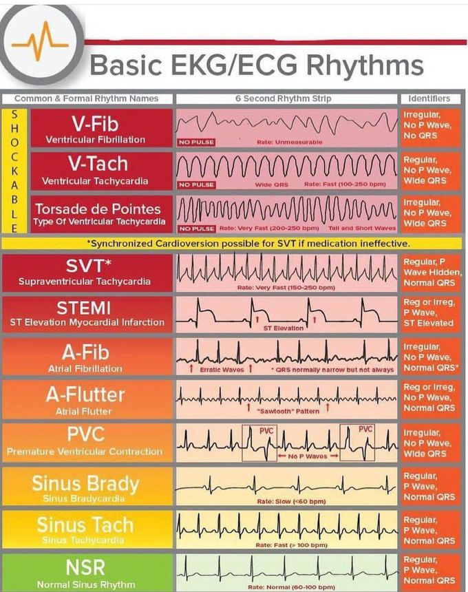Basic ECG Rhythms - MEDizzy