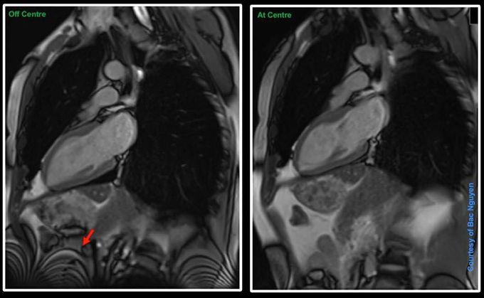 Cardiac positioning @ Siemens Be careful positioning the - MEDizzy