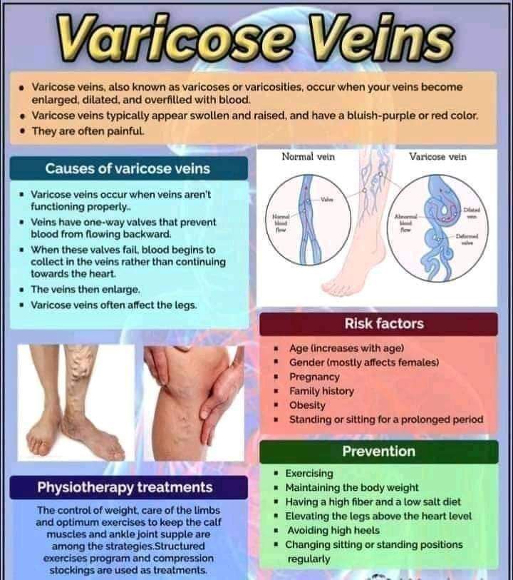 Varicose vein - MEDizzy