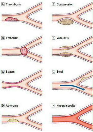 Thrombosis - MEDizzy