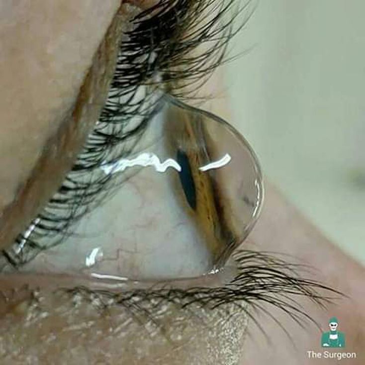 Keratoconus - MEDizzy