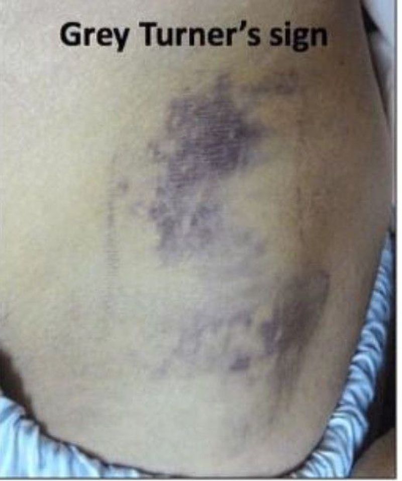 Grey Turner S Sign #enfermeria #pasantedeenfermeria #pancreatitis