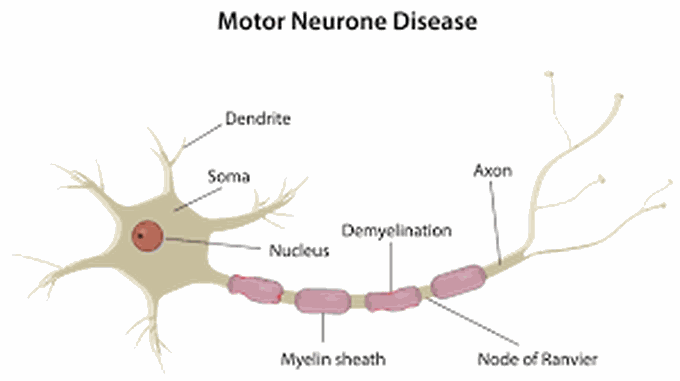 Cause of motor neuron disease - MEDizzy