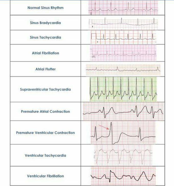Cardiac Rhythms - MEDizzy