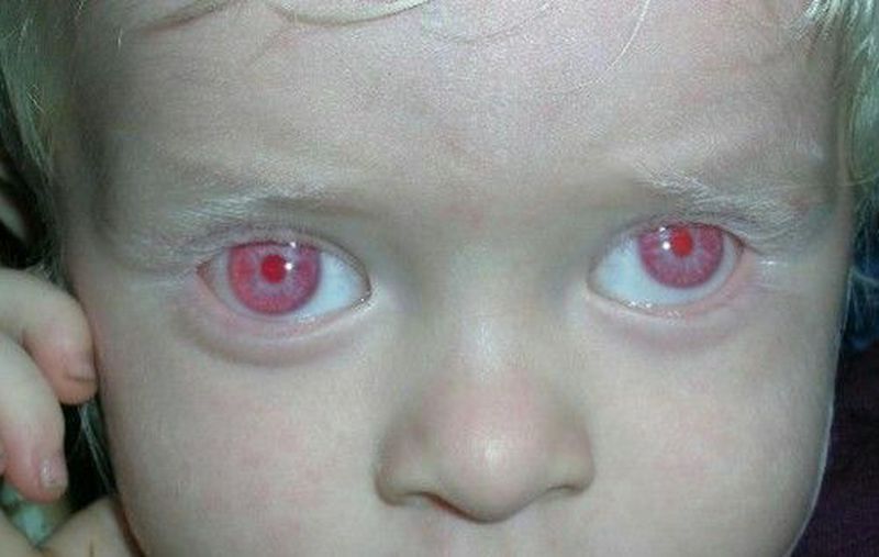 Ocular Albinism Eyes Iris Transillumination In Child With