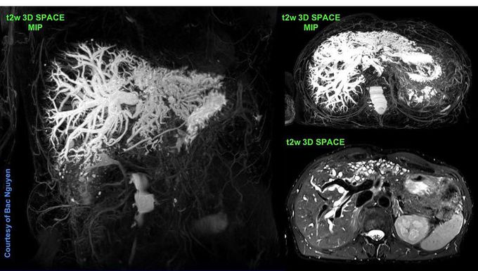 Klatskin tumor @ Siemens 1.5T Aera #Siemens_MRI #siemens - MEDizzy