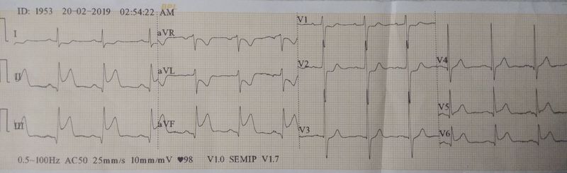 ECG changes - MEDizzy