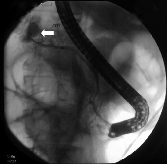 Indications of ERCP - MEDizzy
