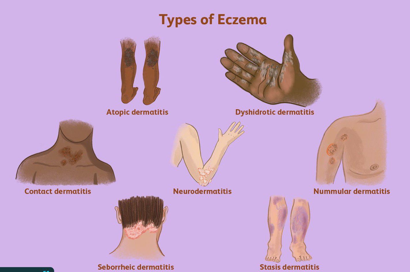Types Of Eczema MEDizzy