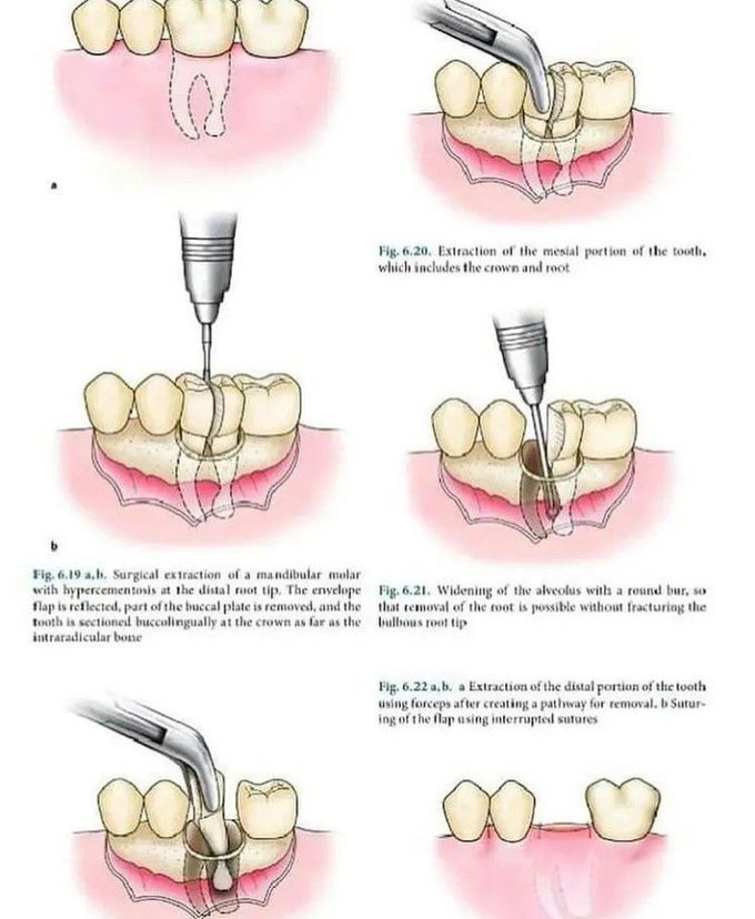 Sectioning and extraction of a tooth having hypercementosis - MEDizzy