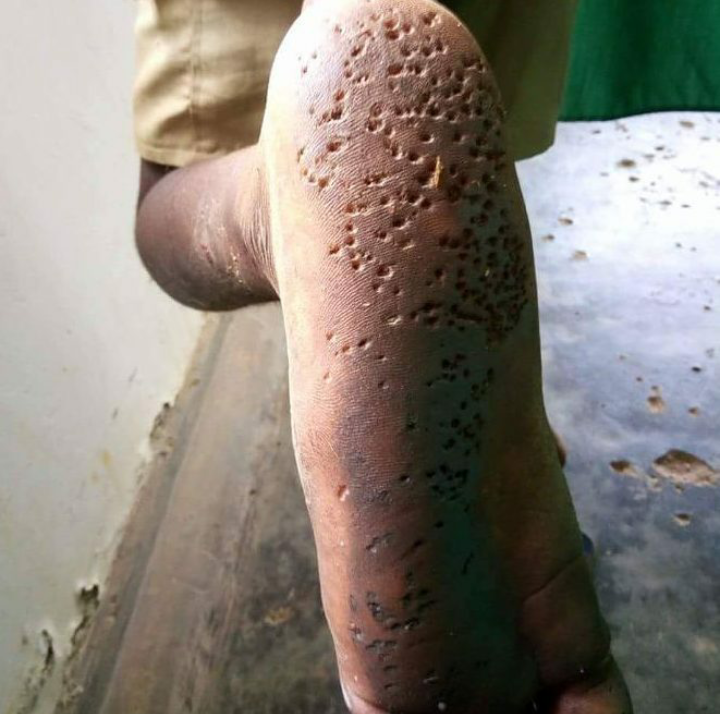 Pitted keratolysis MEDizzy