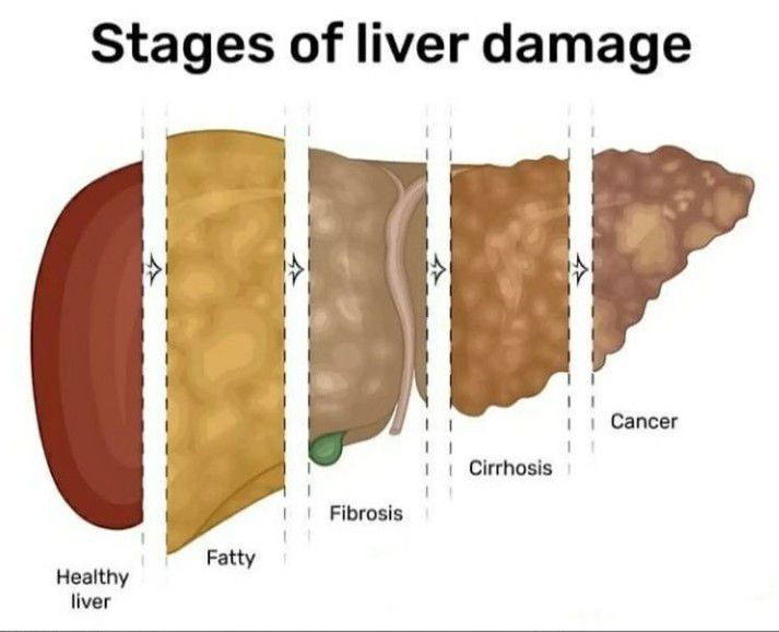 Stages of Liver Damage - MEDizzy