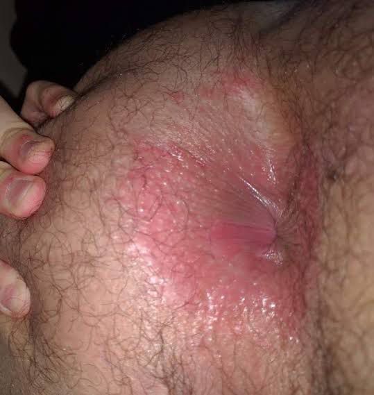 Treatment of itchy anus MEDizzy
