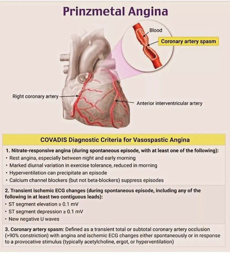 Variant Angina Variant Angina Induced Life Threatening Ventricular