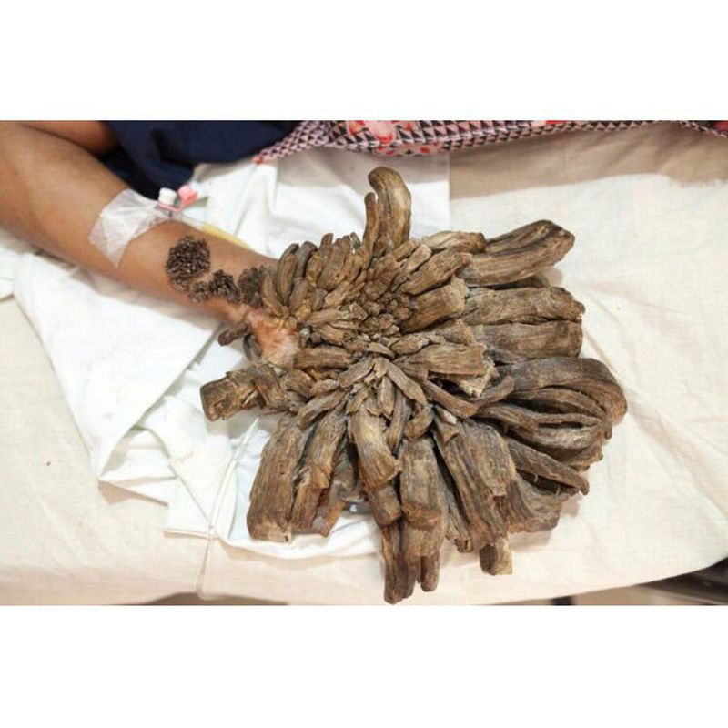 Epidermodysplasie Verruciformis Epidermodysplasia Verruciformis: An