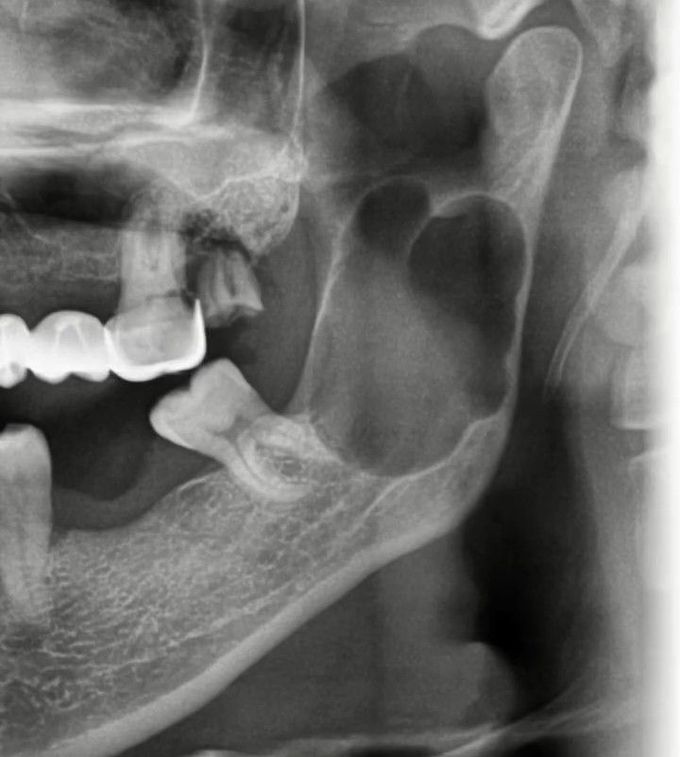Cystostomy - MEDizzy